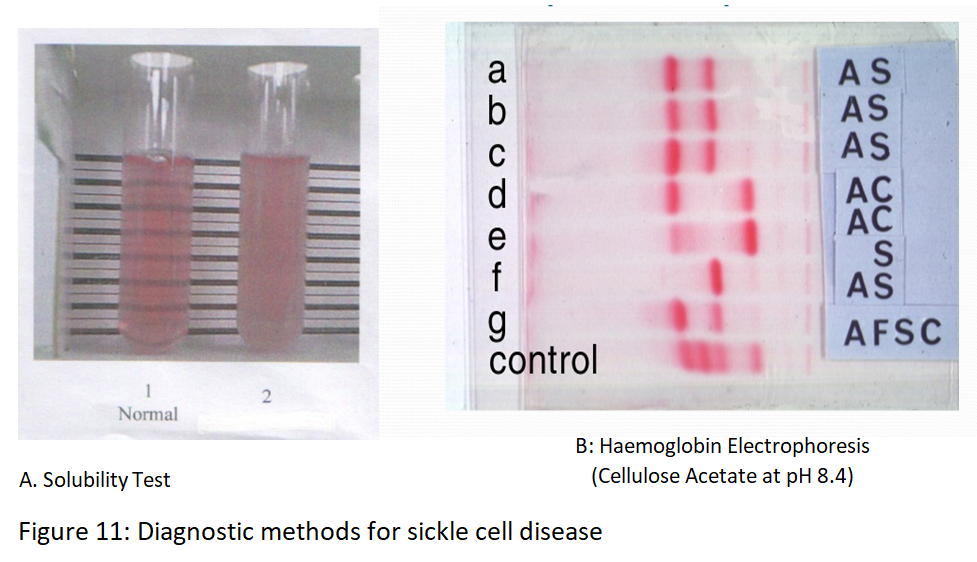SICKLE CELL DISORDER: IMPORTANCE OF SELF-CARE (PART TWO) - The Sickle ...